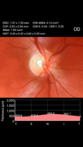 “A retinografia é imprescindível para o diagnóstico de glaucoma”, afirma o oftalmologista e ...
